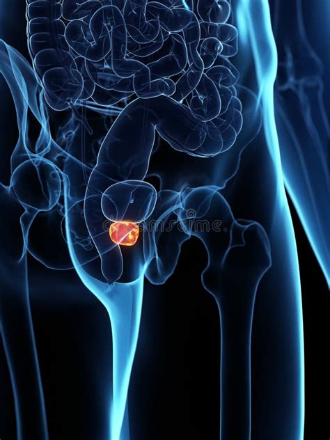An Inflamed Prostate Stock Illustration Illustration Of Infection