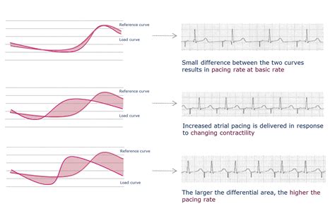 Closed Loop Stimulation Biotronik
