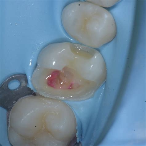 Caries Detector Dye Cdd Increase Bond Strength And Protect The Pulp