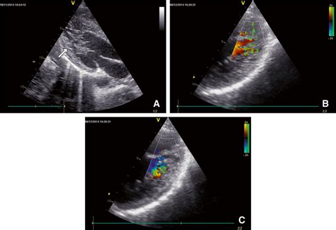 Echocardiography Revealed A Thick Layer Of Spongy Myocardium In The Download Scientific Diagram