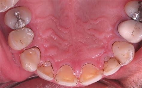 Tooth Surface Loss Due To Dental Erosion