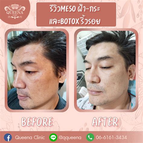 🌟โปรสู้โควิด 19 กดสิว นวดหน้าand ซาลอน By มาดามควีน่า