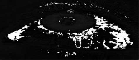 Figure 2 From Severity Based Detection Of Conjunctivitis And Drug