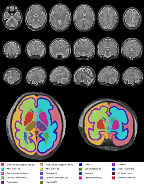Example 3d Slice To Volume Reconstructions Of T2 Weighted Fetal Brain Download Scientific