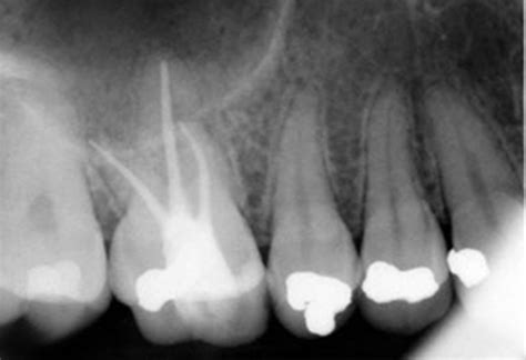 Exp Caries Object Detection Dataset By Magical