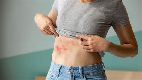 Finding Effective Pain Relief From Shingles Louisiana Pain Care