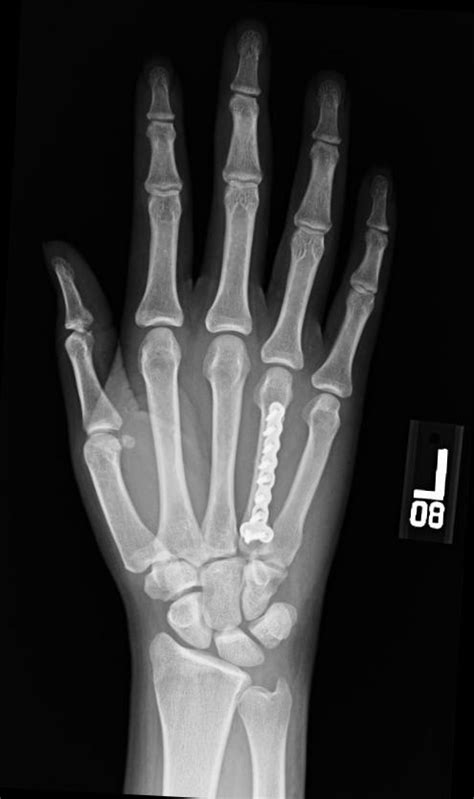 Science Research 2022 Bone Fracture Detection Object Detection Dataset