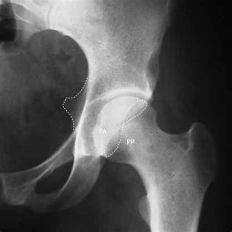 Anteroposterior Radiograph Of The Left Hip In Which Acetabular Download Scientific Diagram