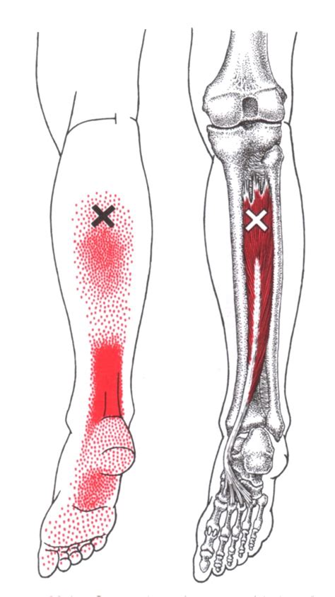 Tibialis Posterior The Trigger Point Referred Pain Guide