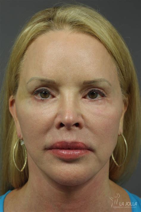 Liquid Facelift Before After Gallery