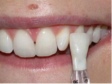 Aesthetic Update The Art Of Clinical Shade Matching Of Resin Based Composite Materials