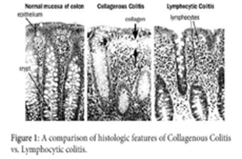 Lymphocytic Colitis