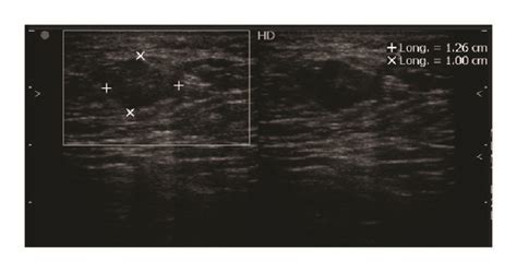 Hypoechoic Nodule With Indistinct Microlobular Margins And Without Download Scientific Diagram