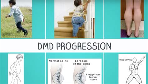 Dmd Hastalığının Ilerlemesi Nasıl Engellenir