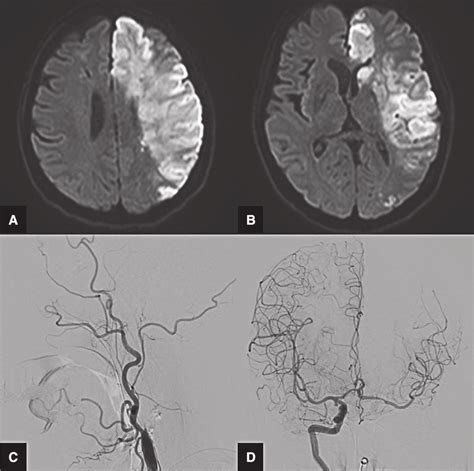 Follow Up Mri And Angiography A And B Postoperative Day 1 Dwi Showed Download Scientific