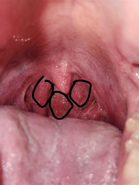 What Are Small Bumps On Back Of Throat