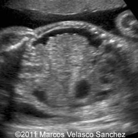📃 Toxoplasmosis With Fetal Hydrops