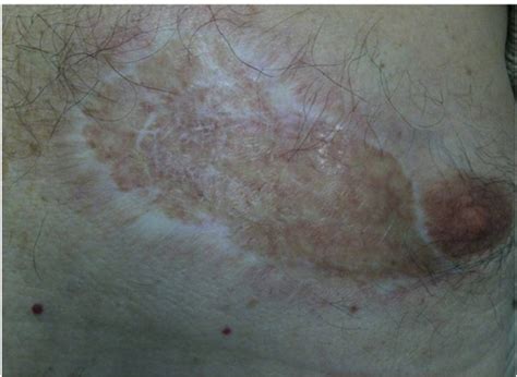 Figure 4 From A Case Of Pyoderma Gangrenosum With Ulcerative Colitis