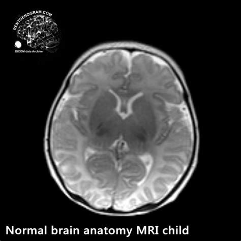 Dicom Normal Brain