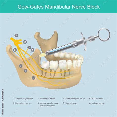 Nerve Block Mandibular Nerve Block Technique