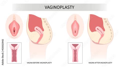 Female Women Genital Of Minor Vulval Labia Loose Lips Beauty Surgery To Tighten Hood Dry Vagina