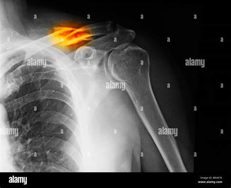 Left Clavicle X Ray