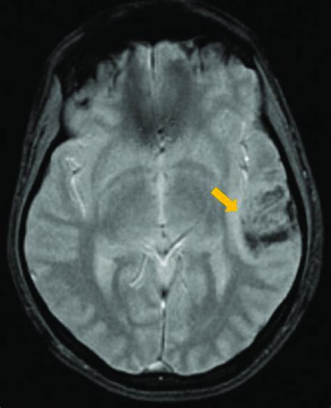 Gradient Echo Brain Sequence Repeated On Day 6 Of Admission Revealed Download Scientific