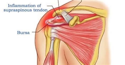 Supraspinatus Tendinopathy Common Cause Of Shoulder Pain Bangalore