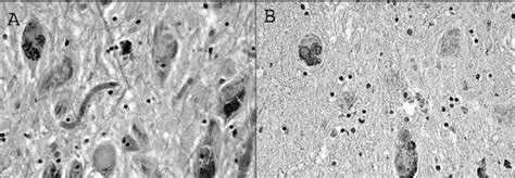 A Lewy Body Hande Original Magnification X 400 B Alpha Synuclein Download Scientific