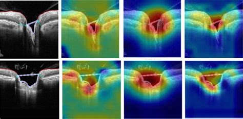 The Gradcam Heatmaps For Vgg16 Resnet18 And Proposed Dl Model Left To