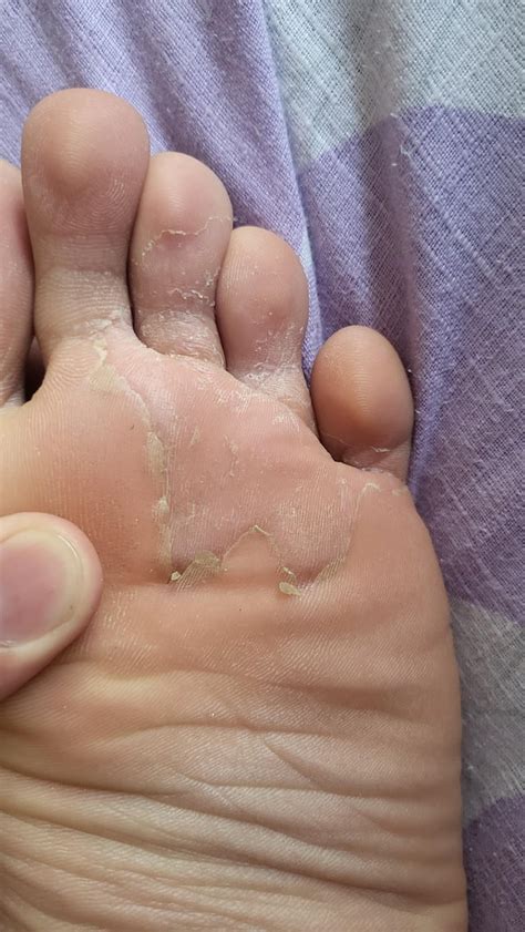 Is This Athletes Foot Rhyperhidrosis