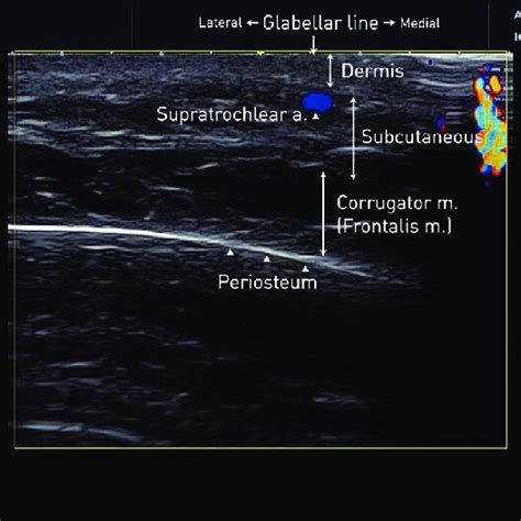 The Supratrochlear Artery Is Located Just Beneath Glabellar Wrinkle Download Scientific Diagram