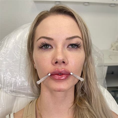 Pdo Threads The Flawless Lab Scottsdale Arizona