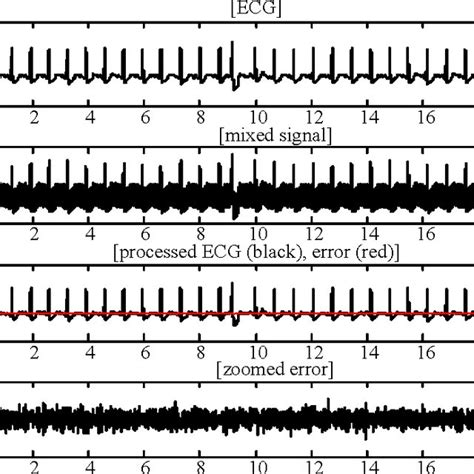 Pdf Power Line Interference Removal From High Sampled Ecg Signals