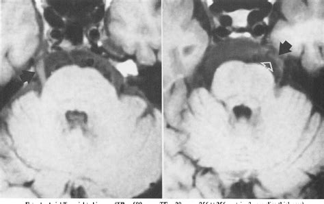 Figure 1 From Magnetic Resonance Imaging Of Vascular Compression In Trigeminal Neuralgia