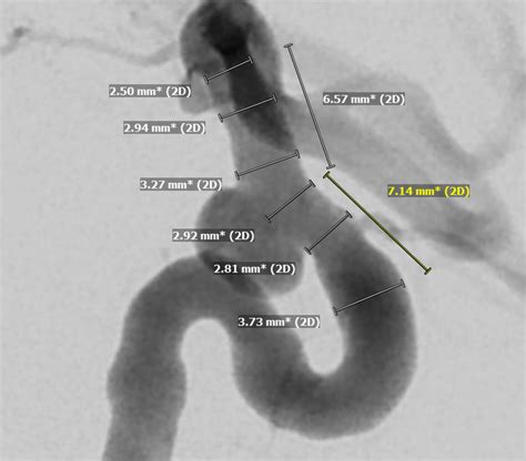 Superior Hypophyseal Aneurysm Pipeline Shield Embolization