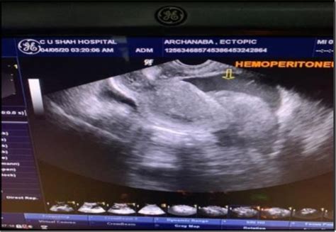 Figure 1 From A Case Report On Ruptured Rudimentary Horn Ectopic Pregnancy Semantic Scholar