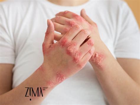 پسوریازیس چیست؟ راه های درمان پسوریازیس زیمالب