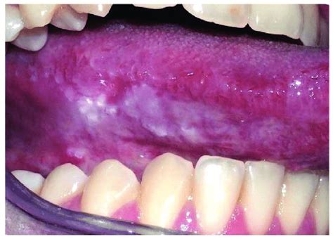 Leukoplakia In The Right Border Of The Tongue With Severe Dysplasia In