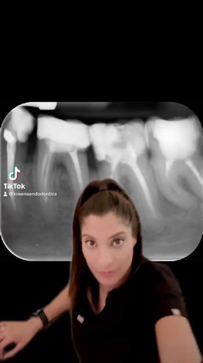 Kreena Patel On Linkedin Endooverdrive Endodontics Endovsimplant Rootcanalretreatment Rct
