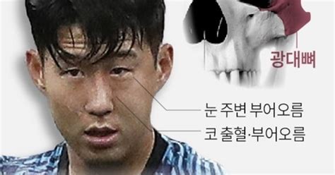 [그래픽] 손흥민 안와 골절 수술