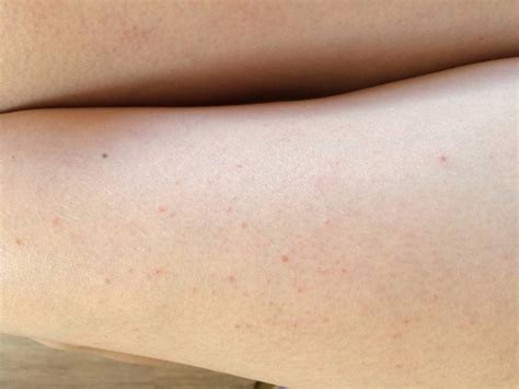 Красные Пятна На Коже Фото Причины — Картинки фотографии