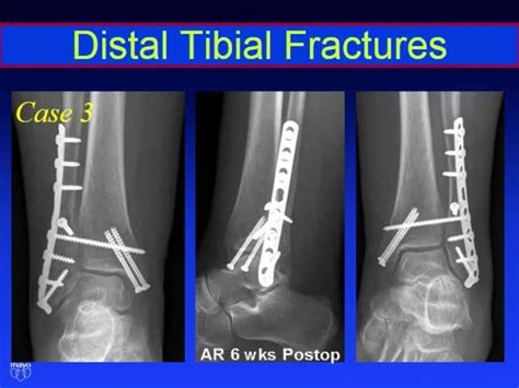 Distal Tibia Fracture Classification