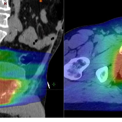 Sagittal And Axial Views Of A Typical Isodose Colour Wash From 10 To Download Scientific
