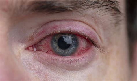 Chlamydia Symptoms Of The Sti Could Include Pink Eye Uk