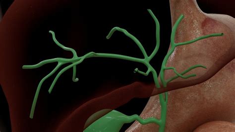 Juan Manuel De Leo González Percutaneous Transhepatic Cholangiogram