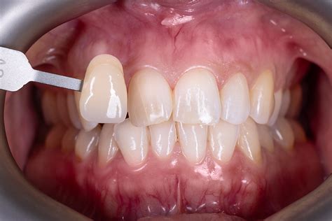 Teeth Whitening Why Dentists Should Offer It
