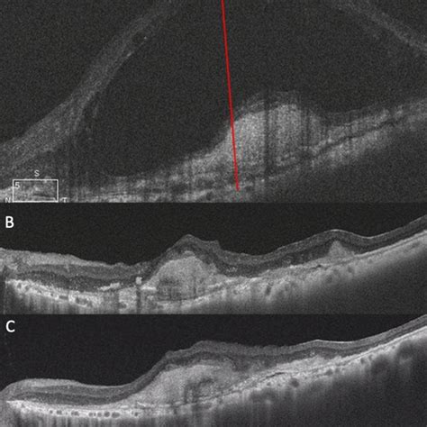 The Patient Had Received Two Monthly Ranibizumab Injections With No Download Scientific Diagram