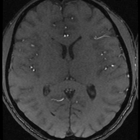 Azygos Anterior Cerebral Artery Radiopaedia 17059 16756 Axial Mra Nc Commons