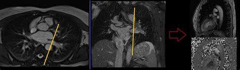 Cardiac Mri Flow Quantification Protocols Planning And Techniques